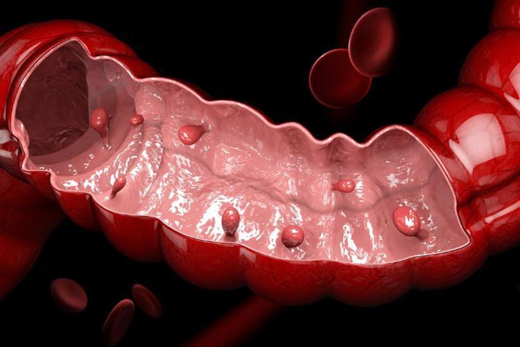 Kolit nedir, neden olur? Kolit belirtileri ve tedavisi hakkında merak ...