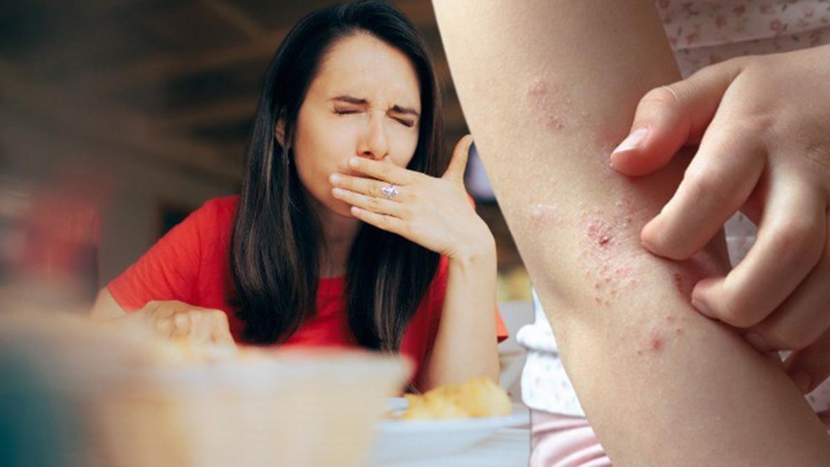 Anafilaktik şok nedir, nasıl anlaşılır? Bu bulgular hayati önem taşıyor ...