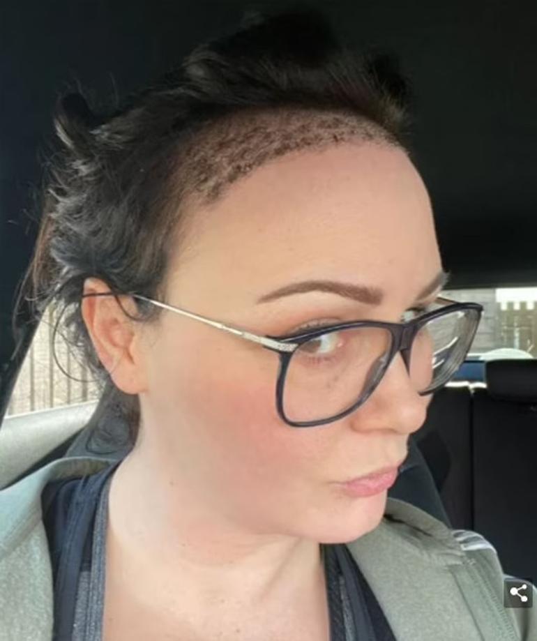 TV yıldızı Chanelle Hayes 8 saatlik operasyonla saç ektirdi: Kendimden ...