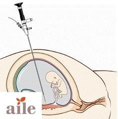 Fetoskopi Uygulaması - Hürriyet Aile