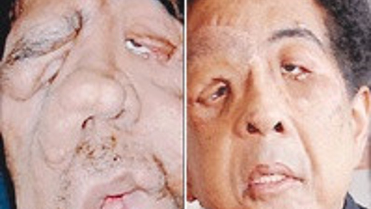 ’Fil Adam’a ilk tam yüz nakli - Hürriyet En Son Haberler